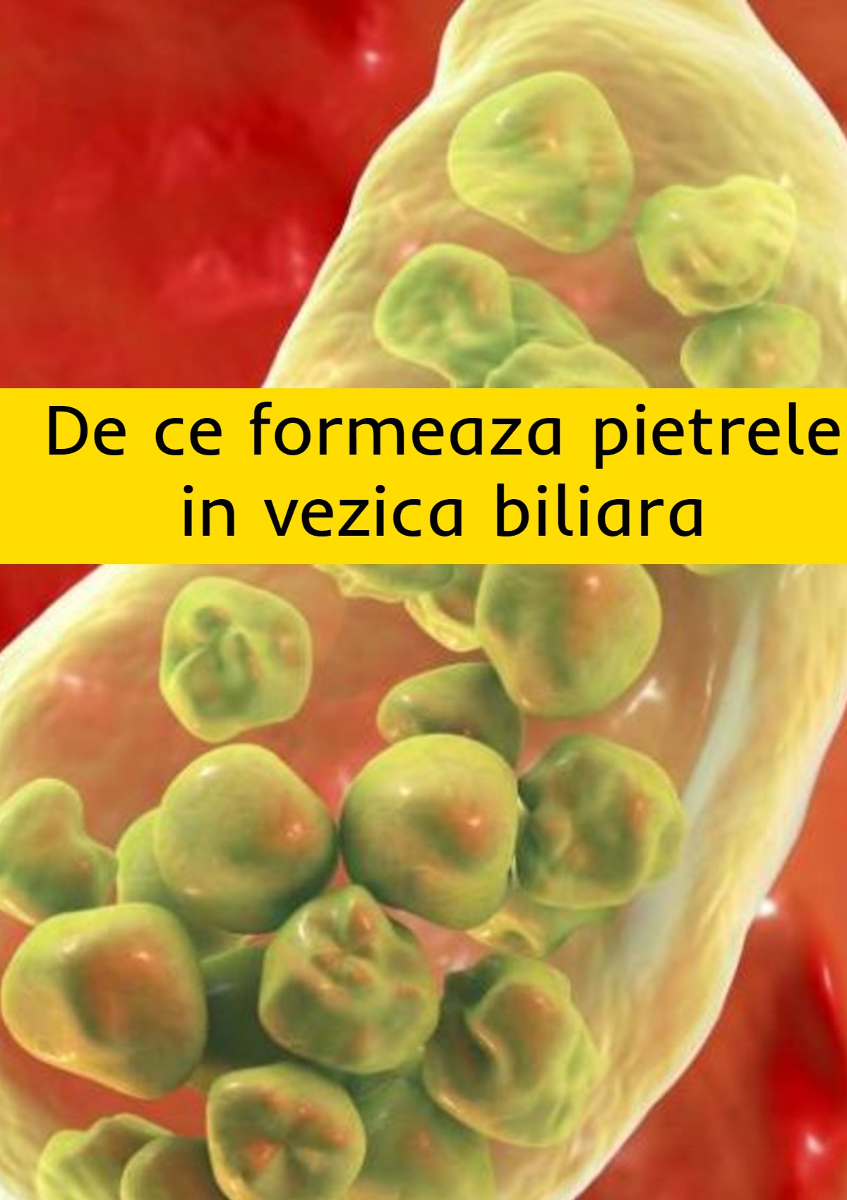 De ce se formeaza pietrele in vezica biliara